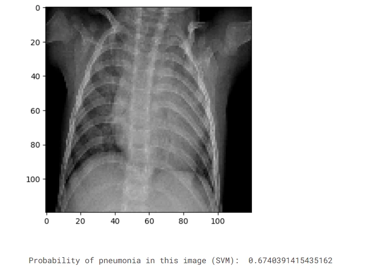 ML Beginner's Guide To Build Pneumonia Detection Model